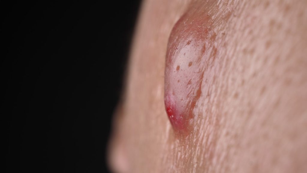 Comment faire mûrir un kyste sans douleur